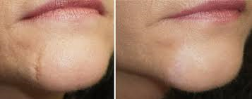 Facial Scar Revision Midtown Manhattan | Reduce Facial Scars NYC